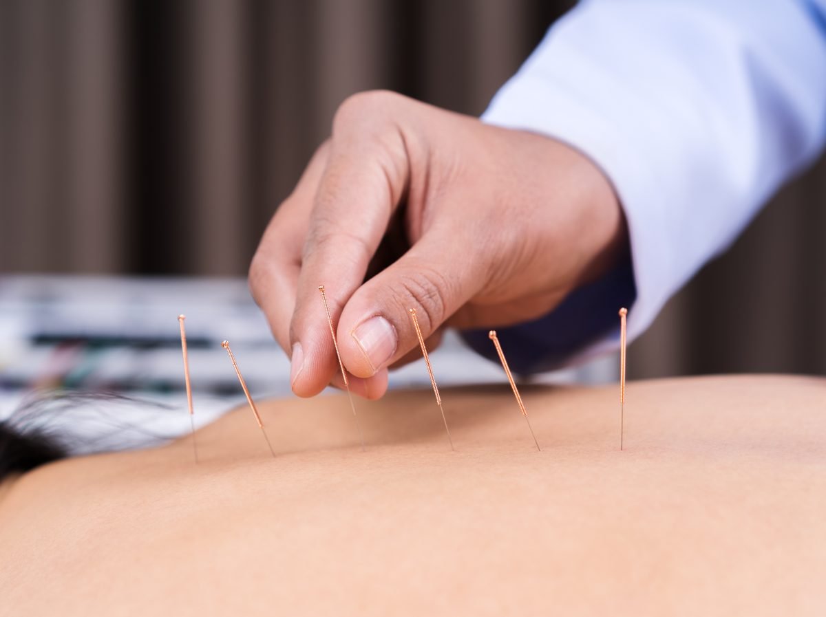 Discover Acupuncture Benefits: Enhancing Health & Wellness